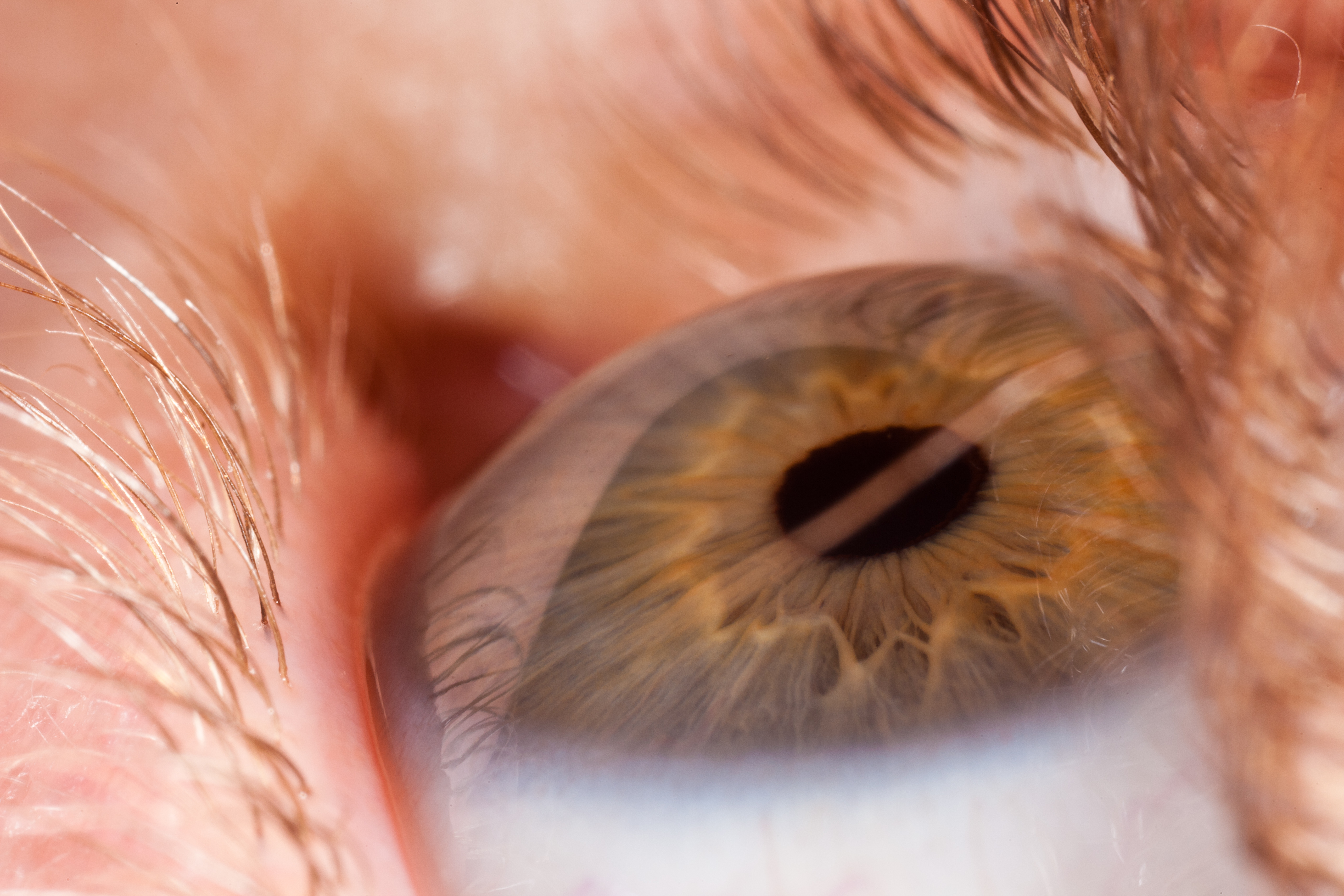 Correcting Astigmatic Error In Cataract Surgery Tal Raviv MD FACS